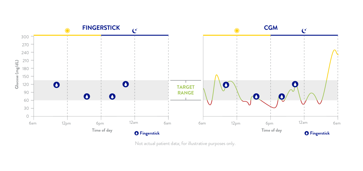Hypoglycemia Cgm Chart